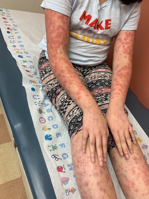 Alarming, Mysterious Skin Rash Healed – sufi 911
